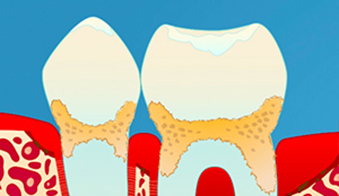 Periodontitt - Tannhelsehuset